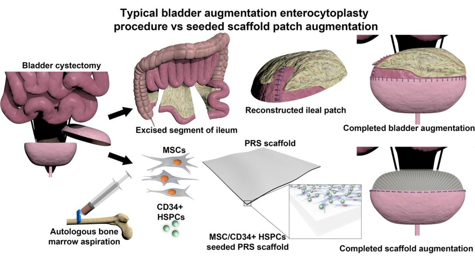 Bladder buzz: technologies to improve bladder surgery and monitoring